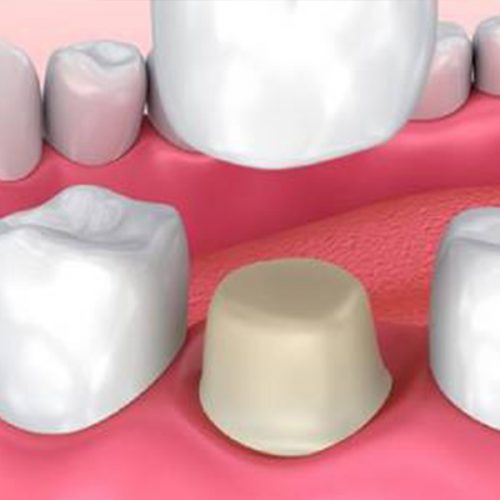 Dental Crowns in Melton – Four Corners Dental